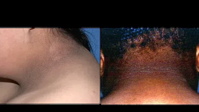 Leher Hitam Bukan Karena Daki, Bisa Jadi Pertanda Sakit Ini