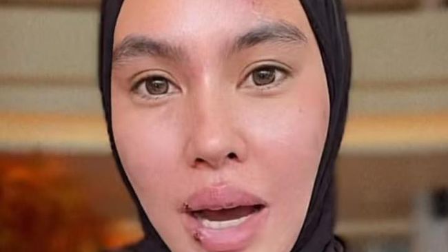 Mengenal Penyebab dan Gejala Sindrom Stevens Johnson, Penyakit yang ...