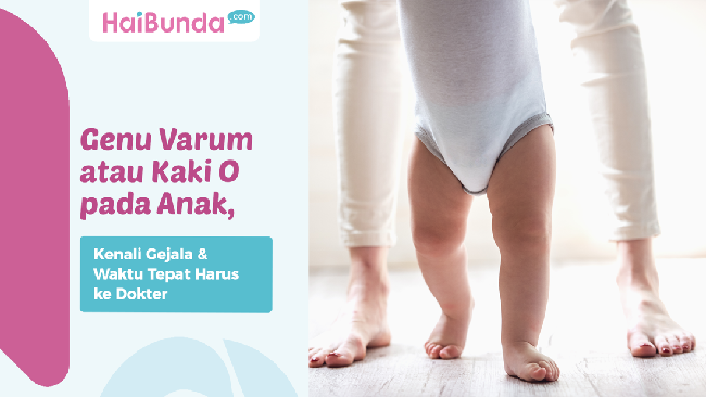 Genu Varum atau Kaki O pada Anak, Kenali Gejala & Waktu Tepat Harus ke Dokter