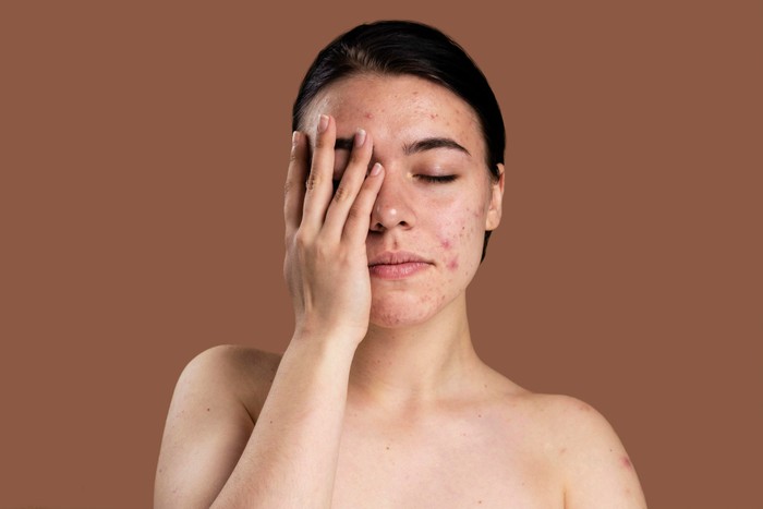 Ini Perbedaan Jerawat Hormonal dan Bakteri, Ketahui Agar Mendapatkan ... Ini Perbedaan Jerawat Hormonal dan Bakteri, Ketahui Agar Mendapatkan ...