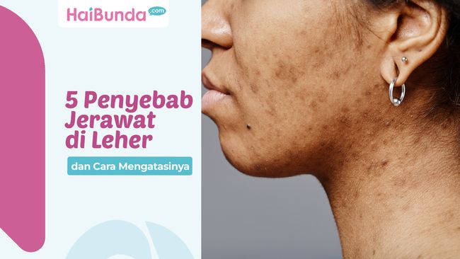 5 Penyebab Jerawat Di Leher Dan Cara Mengatasinya
