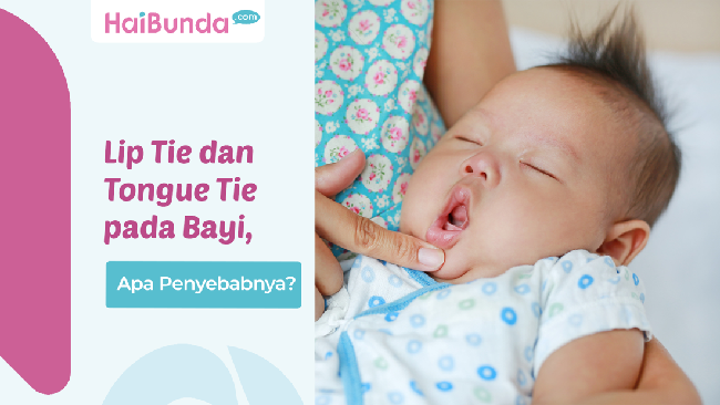 Lip Tie dan Tongue Tie pada Bayi, Apa Penyebabnya?