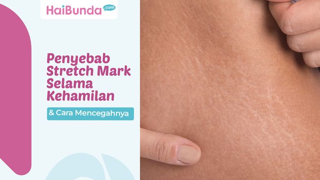 Penyebab Stretch Mark Selama Kehamilan Dan Cara Mencegahnya