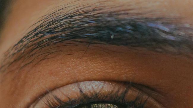 Ternyata Ketombe Bisa Muncul di Alis! Apa Penyebabnya?